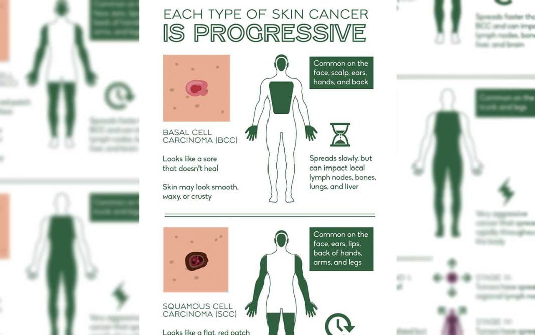 Save Your Skin From this Dangerous Disease. How to Detect Skin Cancer.