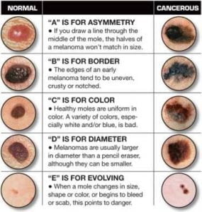 Save Your Skin From this Dangerous Disease. How to Detect Skin Cancer.